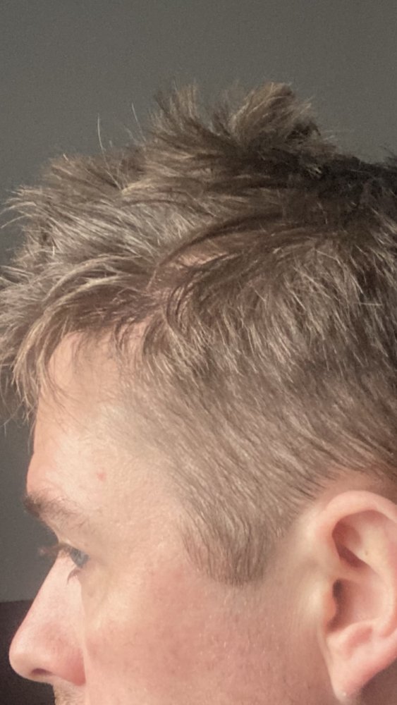 Temples - hair angle and direction | Hair loss Forum - Hair Transplant ...