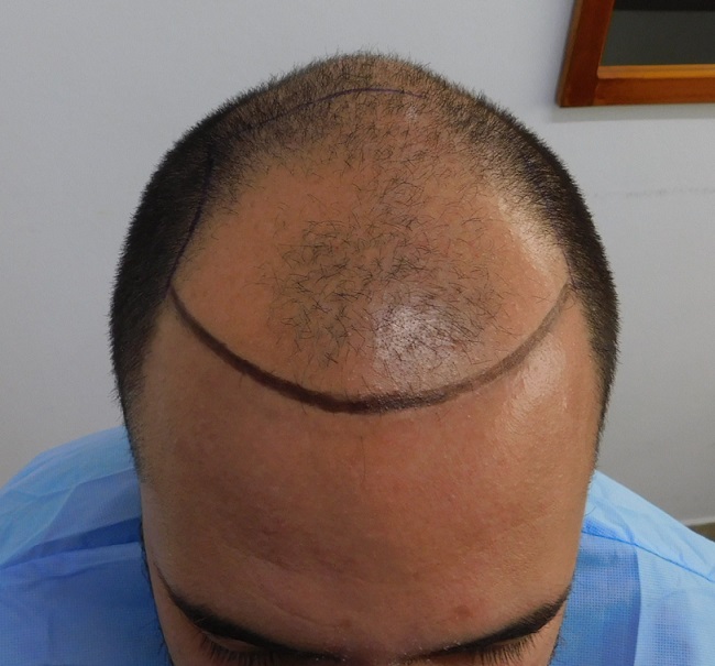 Result of 5000 grafts on NW Class 5 – Giga Session – HDC Hair Clinic ...