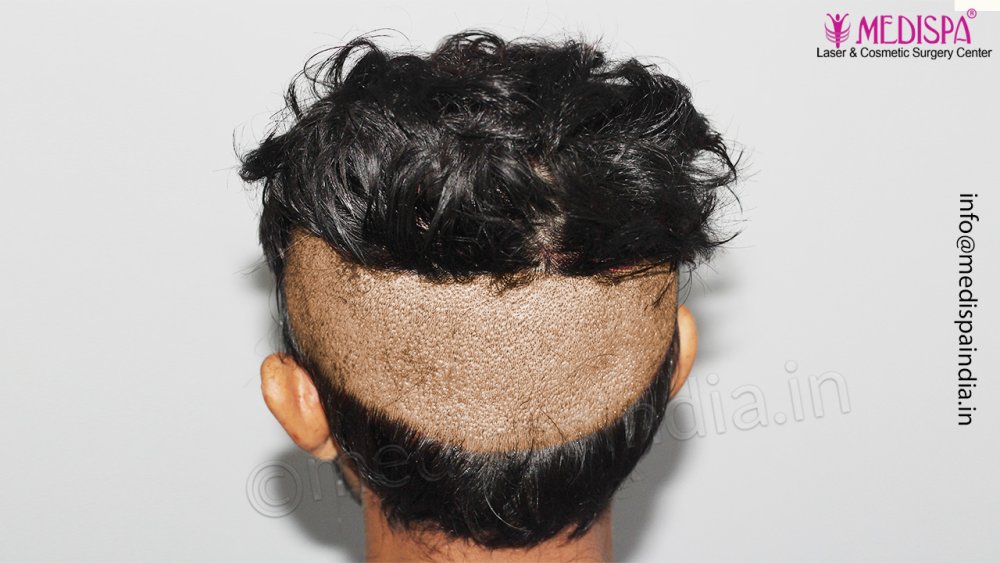 Dr. Suneet Soni - 3029 FUE Grafts, FUE Method (Trivellini System), NW - III