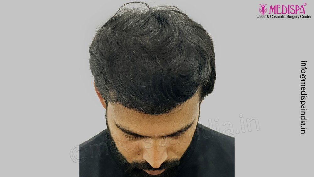 Dr. Suneet Soni - 3029 FUE Grafts, FUE Method (Trivellini System), NW - III