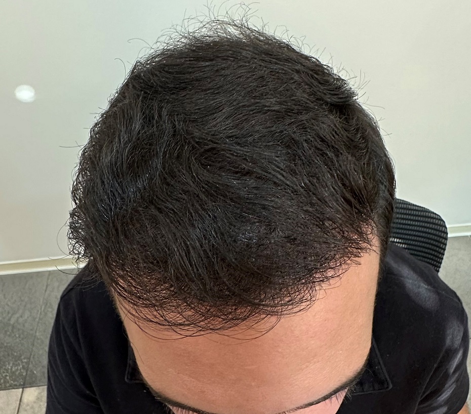 Result of 5000 grafts on NW Class 5 – Giga Session – HDC Hair Clinic ...