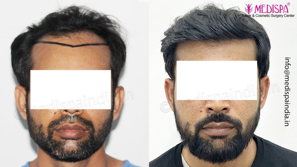 Dr. Suneet Soni - 3029 FUE Grafts, FUE Method (Trivellini System), NW - III