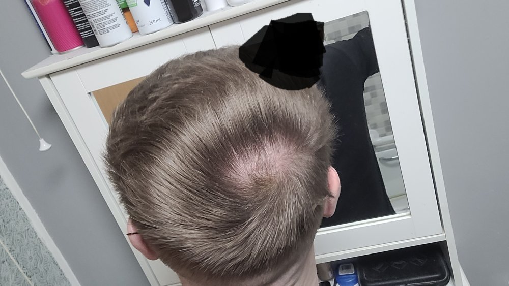 Month 8 finasteride (crown looks worse) | Hair loss Forum - Hair ...