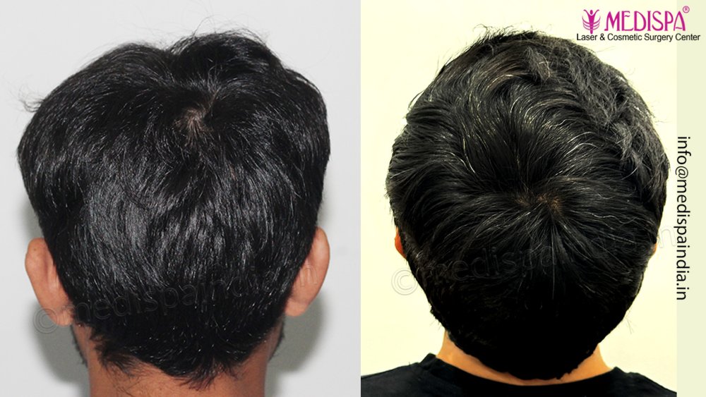 Dr. Suneet Soni - 3029 FUE Grafts, FUE Method (Trivellini System), NW - III