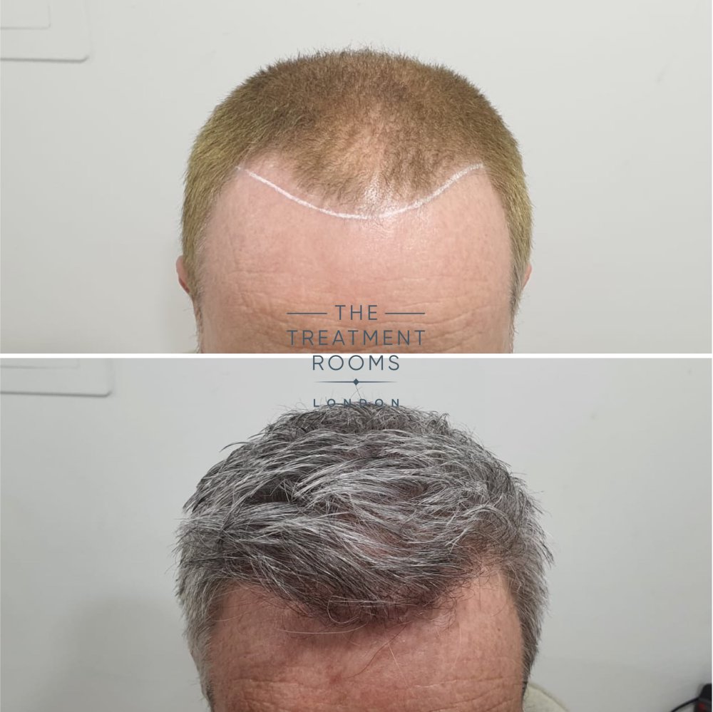 2322 Grafts Hairline and Crown FUE Hair Transplant