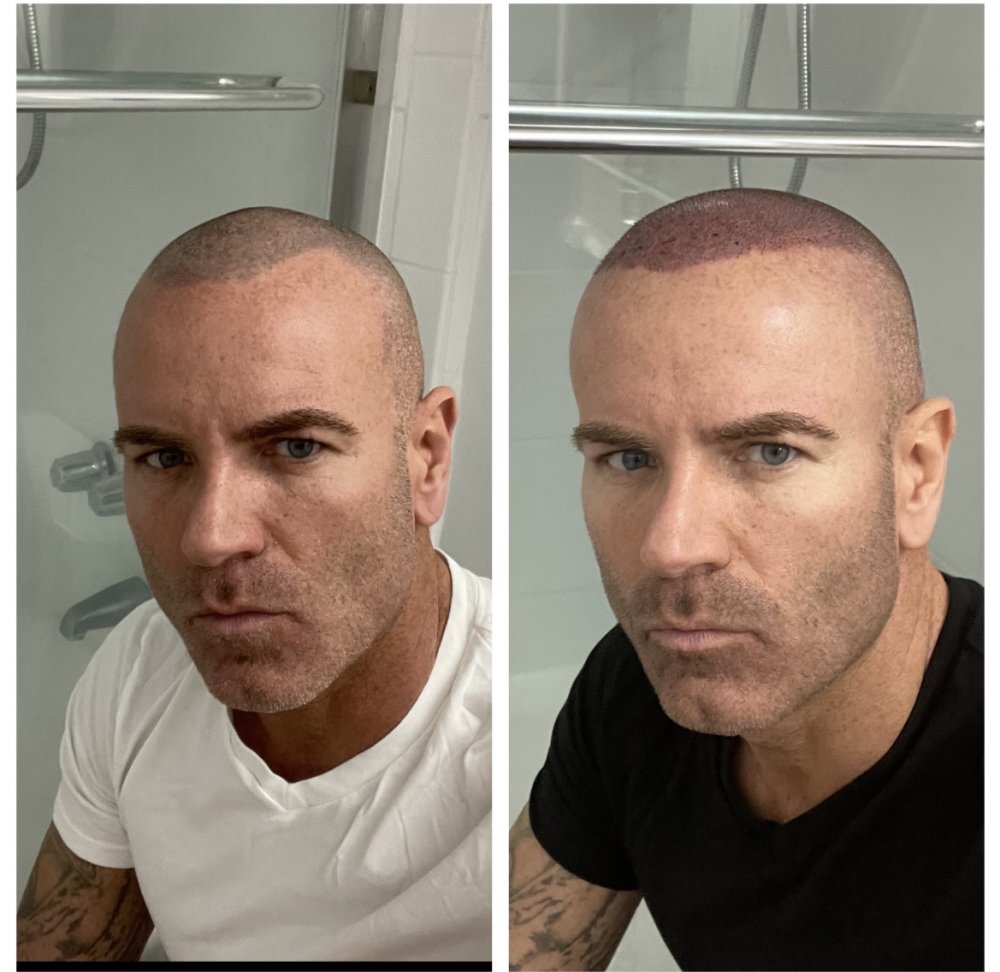 12hr post FUE... hairline has gaps | Hair loss Forum - Hair Transplant ...