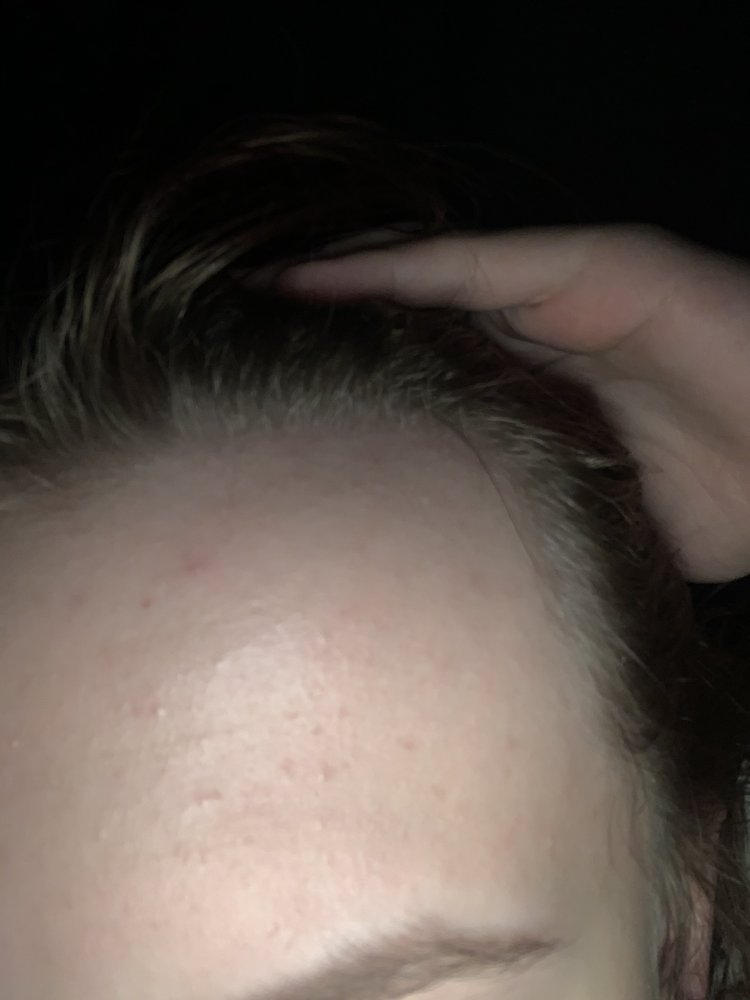 Am i balding at 14? | Hair loss Forum - Hair Transplant forums