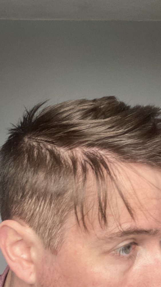 Temples - hair angle and direction | Hair loss Forum - Hair Transplant ...