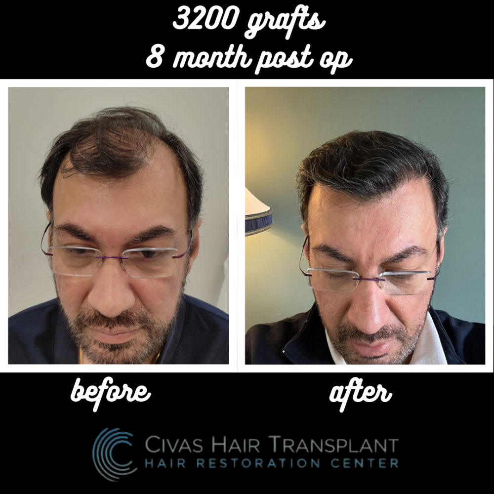 CIVAS HAIR TRANSPLANT--3200 grafts--fue--8 Months