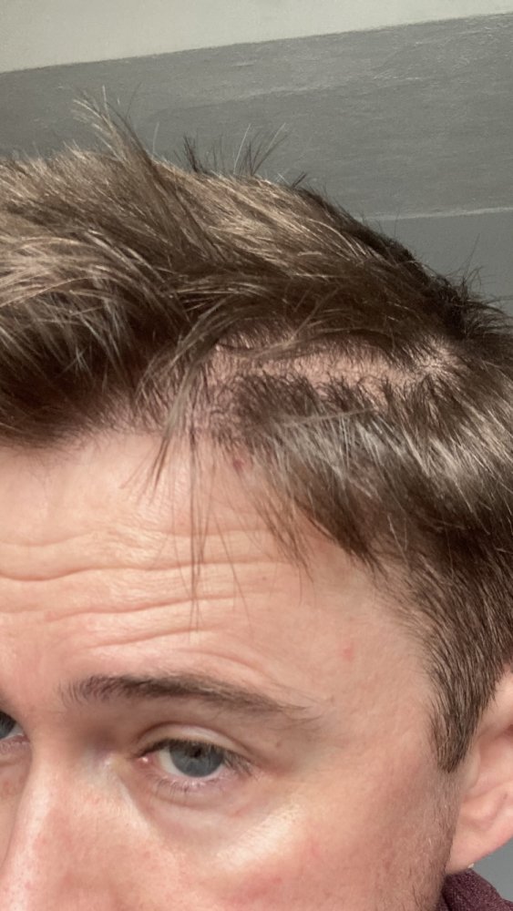 Temples - hair angle and direction | Hair loss Forum - Hair Transplant ...