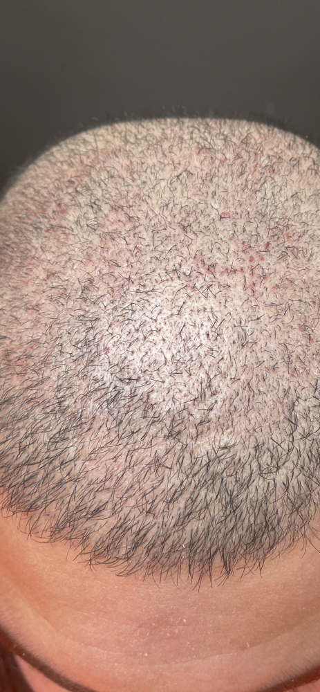 2nd HT 2500 grafts mid scalp + front& back zone 250/250. 3000 total ...