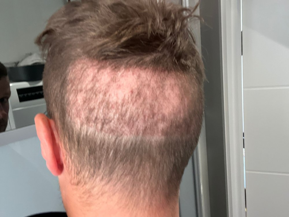 Donar area recovery | Hair loss Forum - Hair Transplant forums