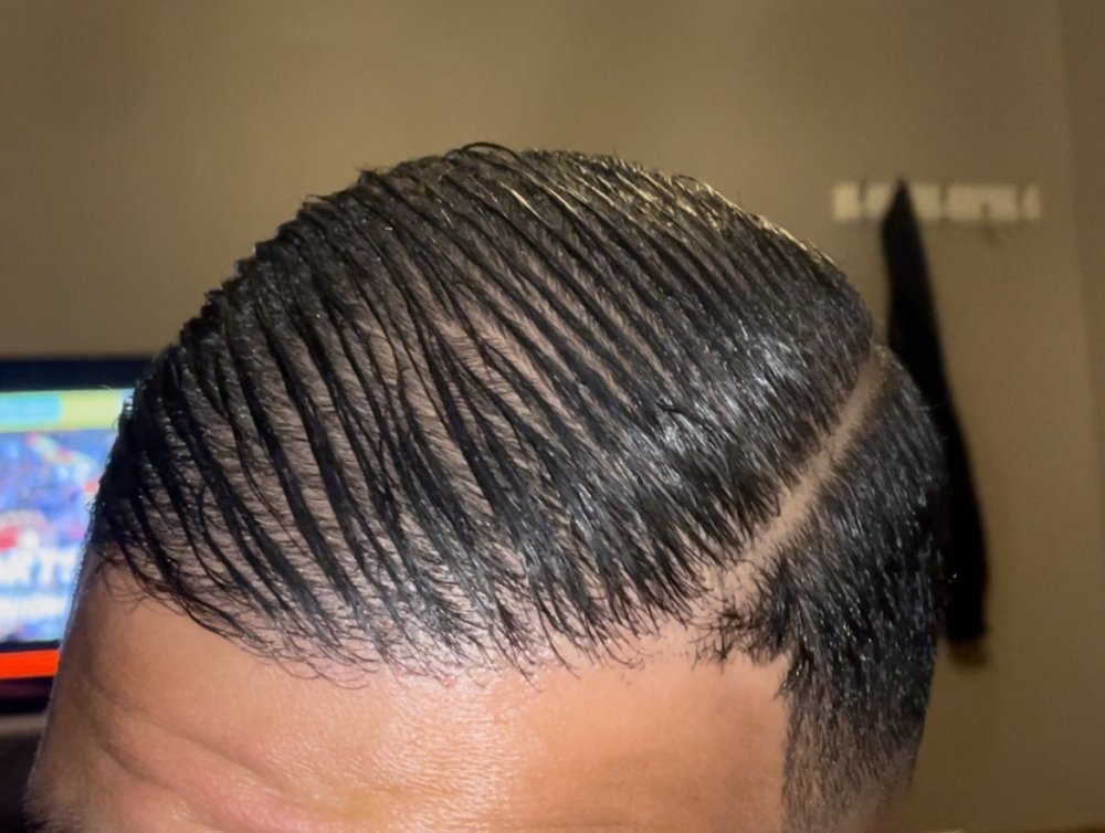 2nd HT 2500 grafts mid scalp + front& back zone 250/250. 3000 total ...