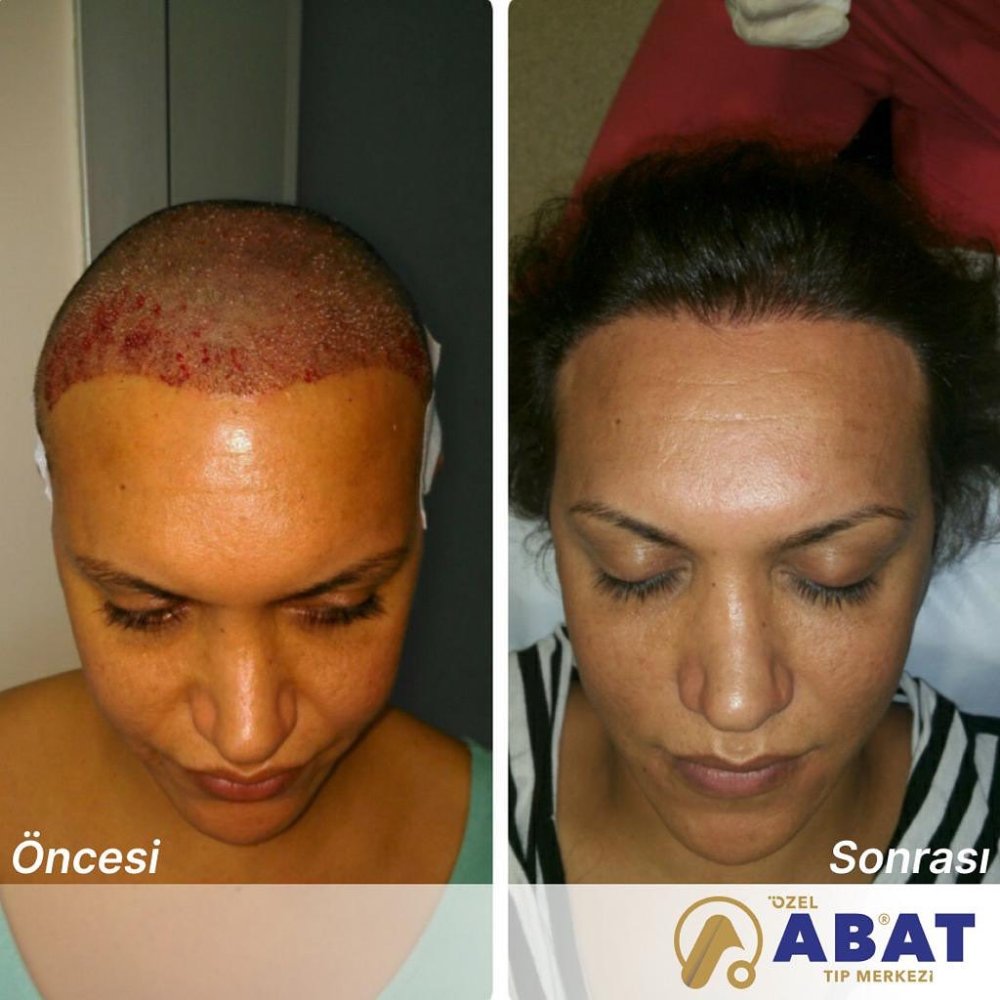 Hair transplant at Abat Surgical Medical Center | Hair loss Forum ...