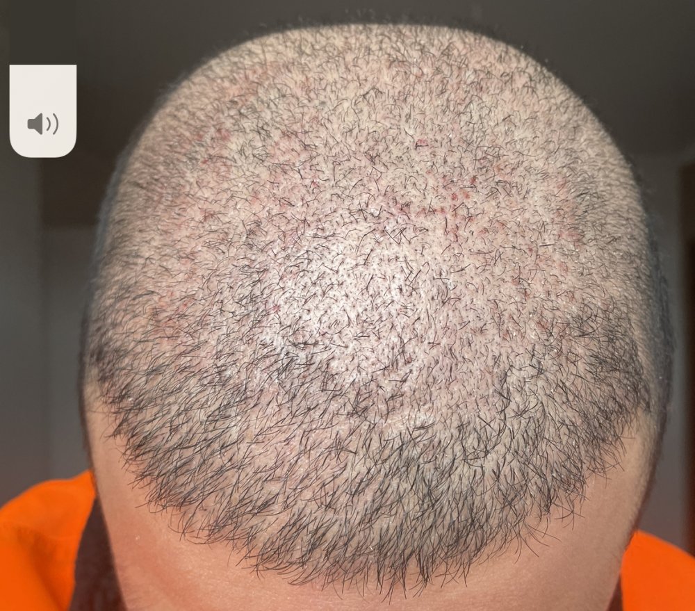 2nd HT 2500 grafts mid scalp + front& back zone 250/250. 3000 total ...