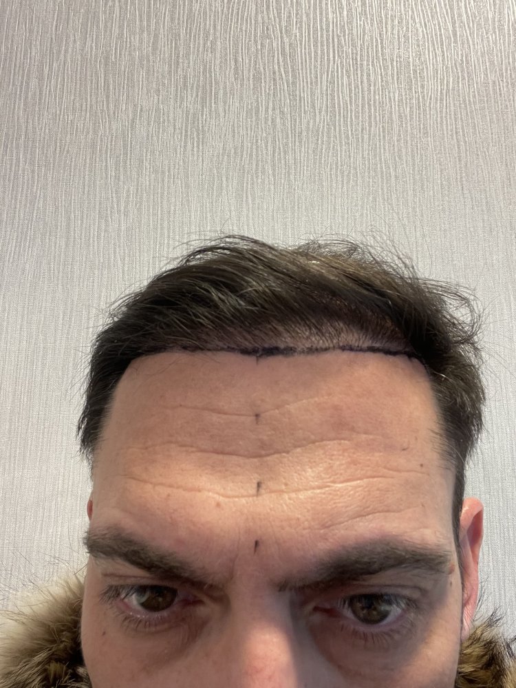 CİNİK - Istanbul, Turchia -4000 uf (anteriore, testa centrale, vertice ...