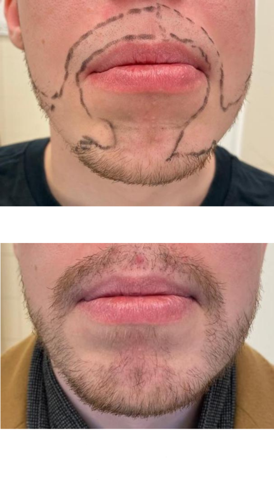 Hair transplant clinic Rubenhair Latvia with ISHRS surgeon | Hair loss ...