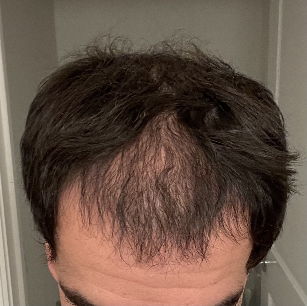 Uneven/patchy growth after nearly 5 months post-FUE (detailed picture ...