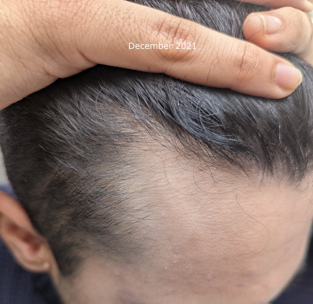 Father trying save his 17 year old from MPB | Hair loss Forum - Hair ...