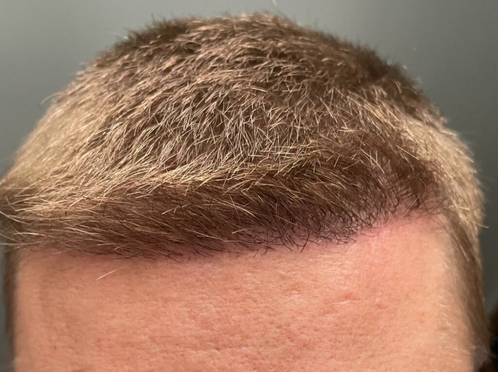 Unnatural Hairline - Repaired by Dr Cooley | Hair loss Forum - Hair ...