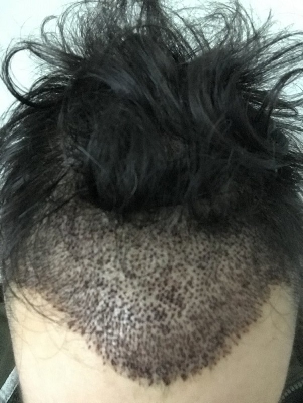 FUE 4th day post op with Farjo Hair Institute | Hair loss Forum - Hair ...