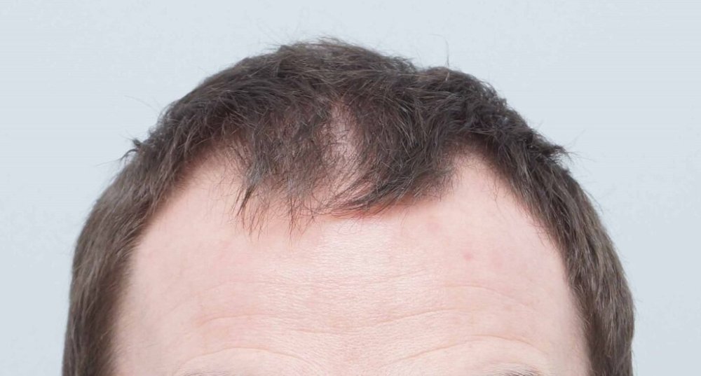 Crown FUE Hair Transplant - Farjo Hair Institute. | Hair loss Forum ...