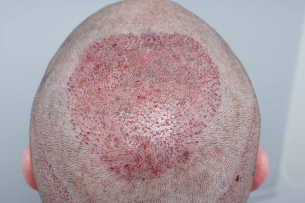 Crown FUE Hair Transplant - Farjo Hair Institute. | Hair loss Forum ...