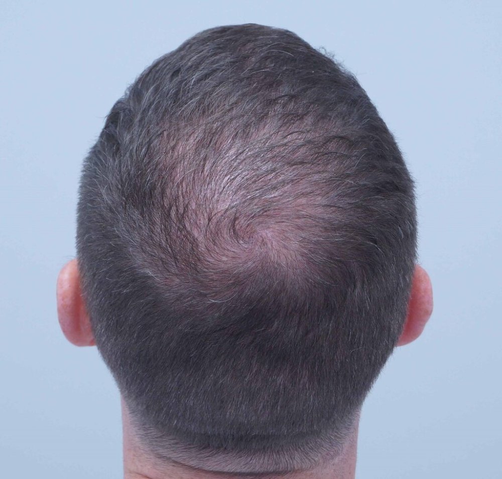 Crown FUE Hair Transplant - Farjo Hair Institute. | Hair loss Forum ...