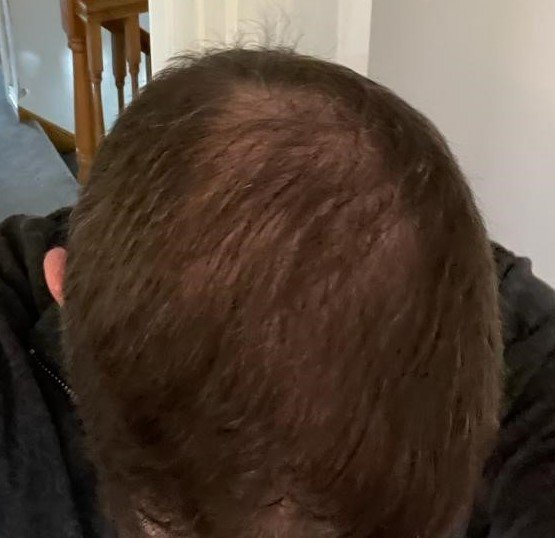 Crown FUE Hair Transplant - Farjo Hair Institute. | Hair loss Forum ...