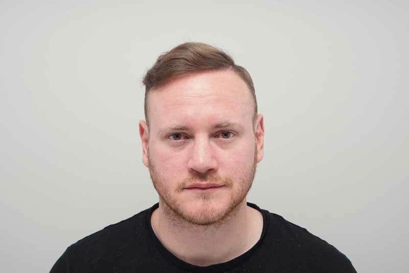 George Groves Hair Transplant at Farjo Clinic | Hair loss Forum - Hair ...