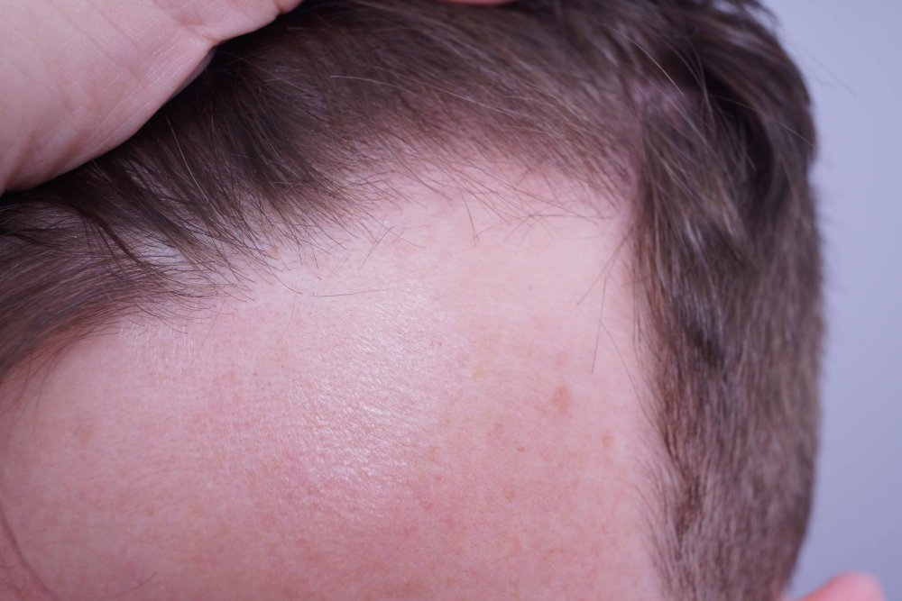 Dr B Farjo 1524 FUE to front | Hair loss Forum - Hair Transplant forums