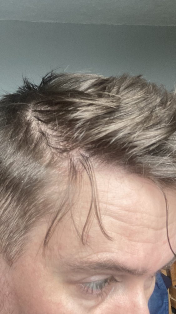 Temples - hair angle and direction | Hair loss Forum - Hair Transplant ...
