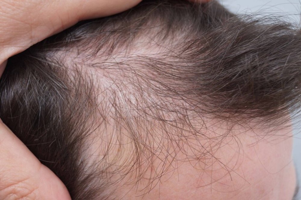 Dr. Bessam Farjo - FUE Hair Transplant | Hair loss Forum - Hair ...