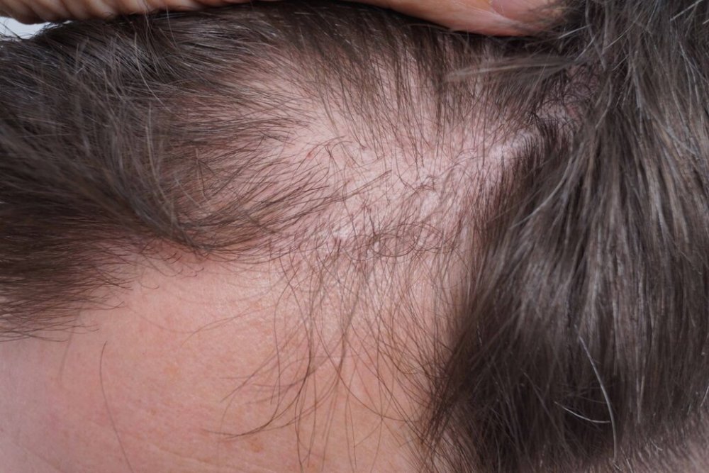 Dr. Bessam Farjo - FUE Hair Transplant | Hair loss Forum - Hair ...