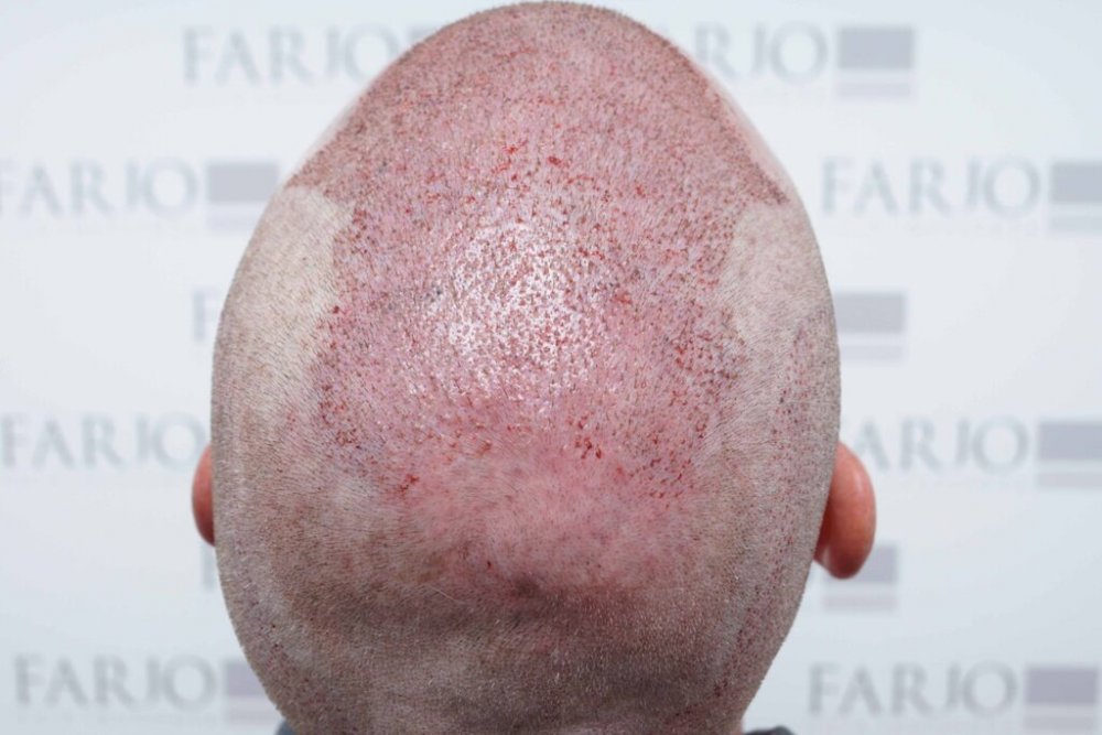 Dr Bessam Farjo 2935 FUE Hair Transplant | Hair loss Forum - Hair ...