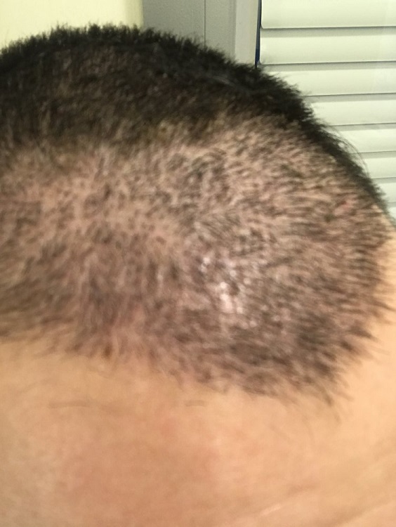 FUE 4th day post op with Farjo Hair Institute | Hair loss Forum - Hair ...