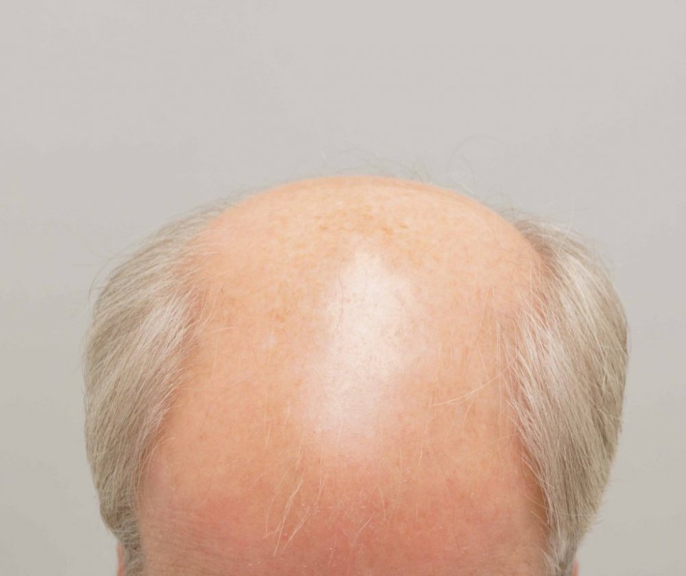 5000 Graft Hair Transplant - Farjo Hair Institute | Hair loss Forum ...