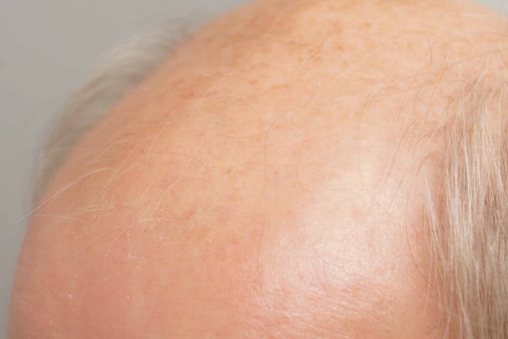 5000 Graft Hair Transplant - Farjo Hair Institute | Hair loss Forum ...