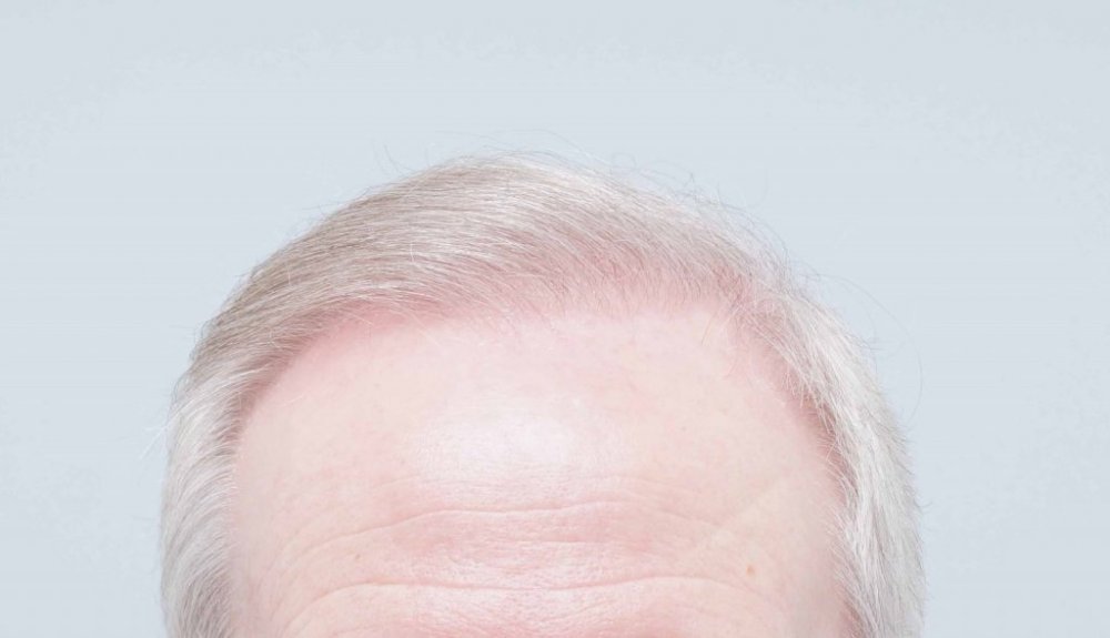 5000 Graft Hair Transplant - Farjo Hair Institute | Hair loss Forum ...
