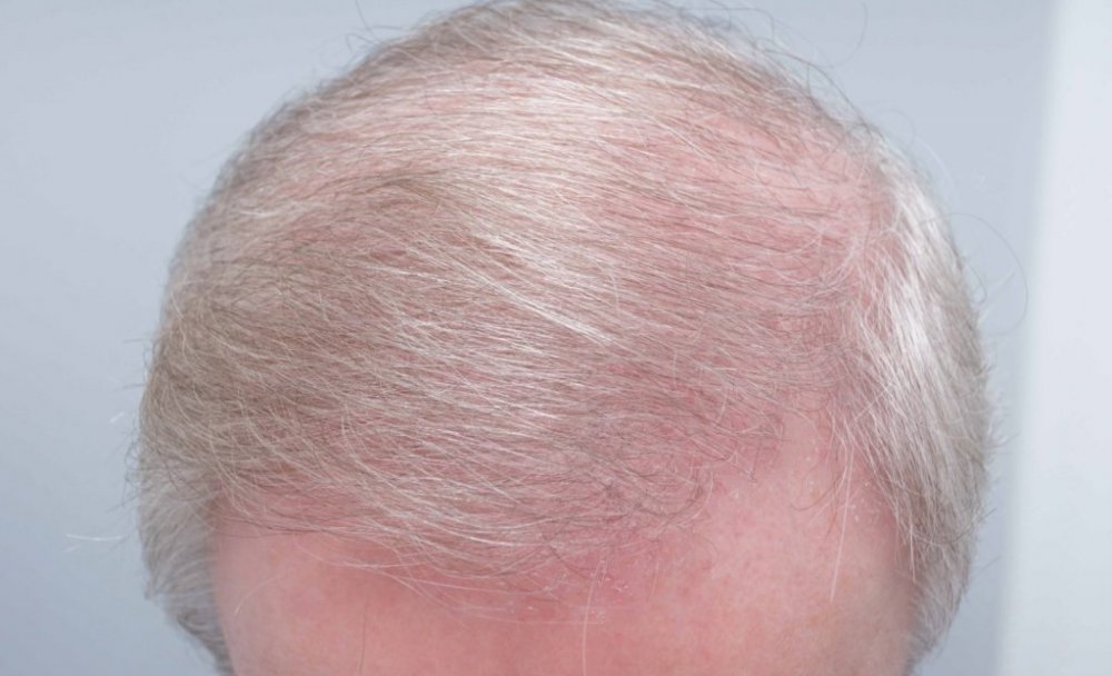 5000 Graft Hair Transplant - Farjo Hair Institute | Hair loss Forum ...