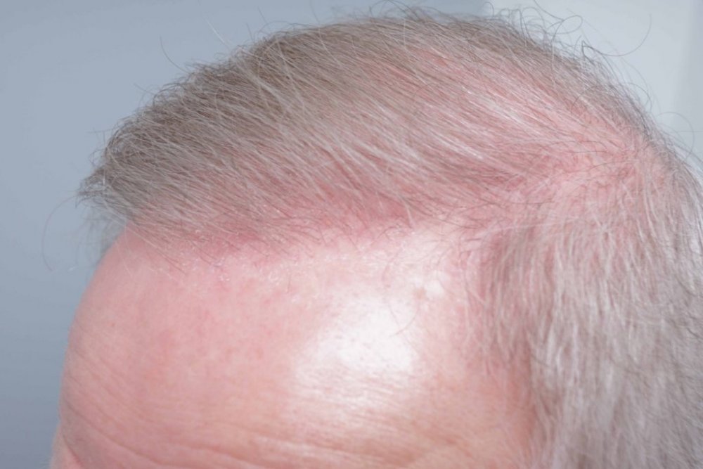 5000 Graft Hair Transplant - Farjo Hair Institute | Hair loss Forum ...