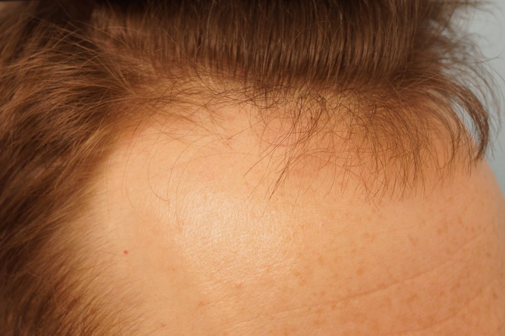 Farjo Hair Institute - FUE Hair Transplant | Hair loss Forum - Hair ...