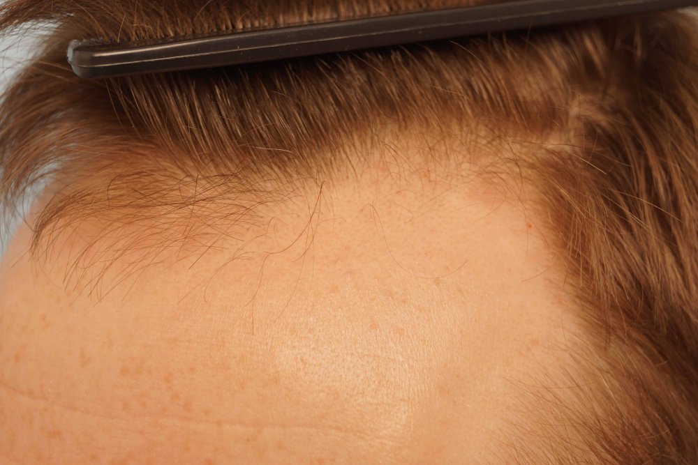 Farjo Hair Institute - FUE Hair Transplant | Hair loss Forum - Hair ...