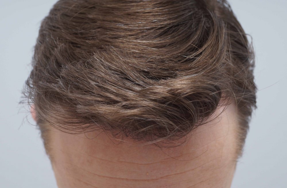Farjo Hair Institute - FUE Hair Transplant | Hair loss Forum - Hair ...