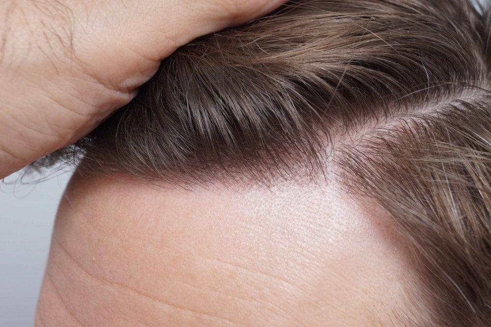 Farjo Hair Institute - FUE Hair Transplant | Hair loss Forum - Hair ...