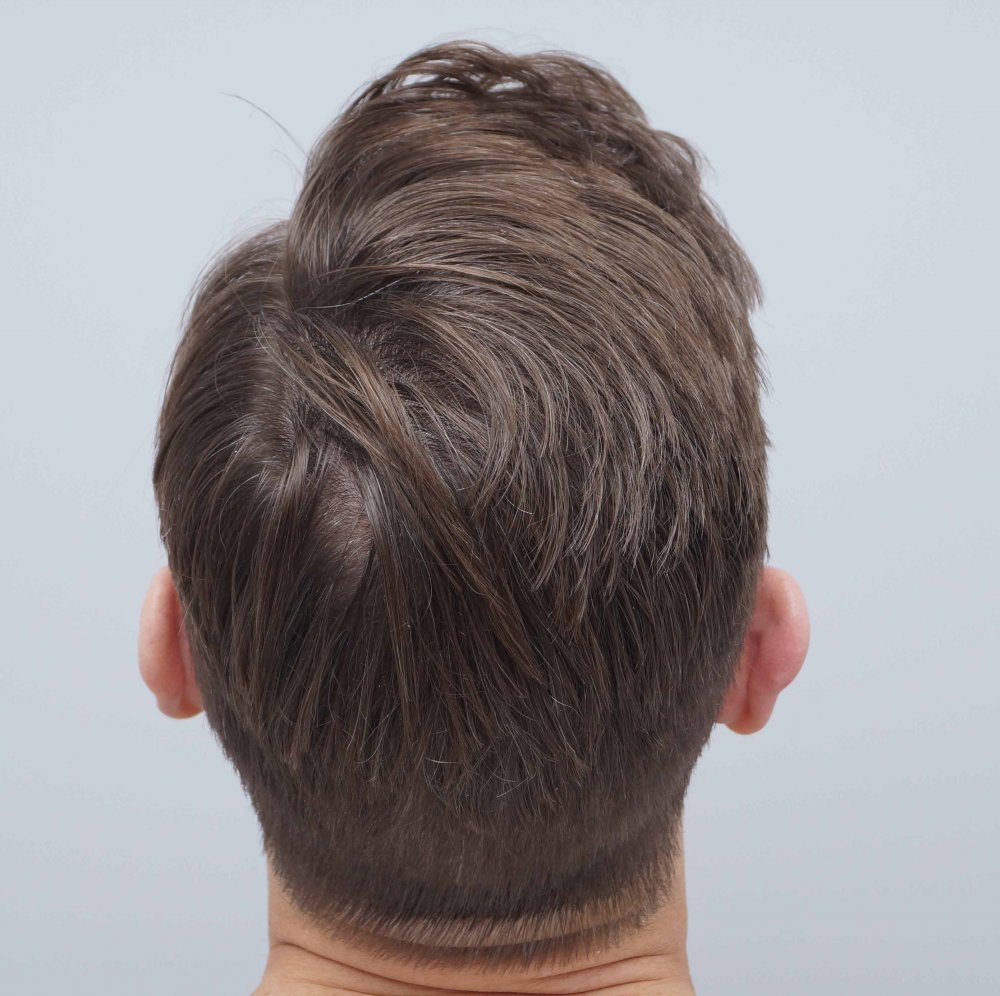 Farjo Hair Institute - FUE Hair Transplant | Hair loss Forum - Hair ...