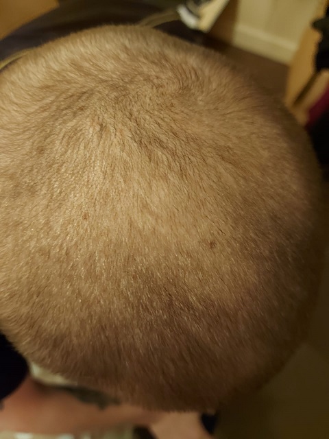 How many grafts do I need? | Page 3 | Hair loss Forum - Hair Transplant ...