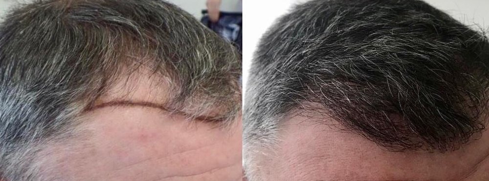 Hair transplant clinic Rubenhair Latvia with ISHRS surgeon | Hair loss ...