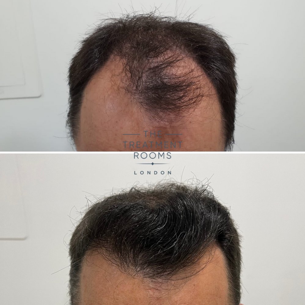 Hairline and Forelock Restoration- 2144 Grafts, FUE Hair Transplant Surgery