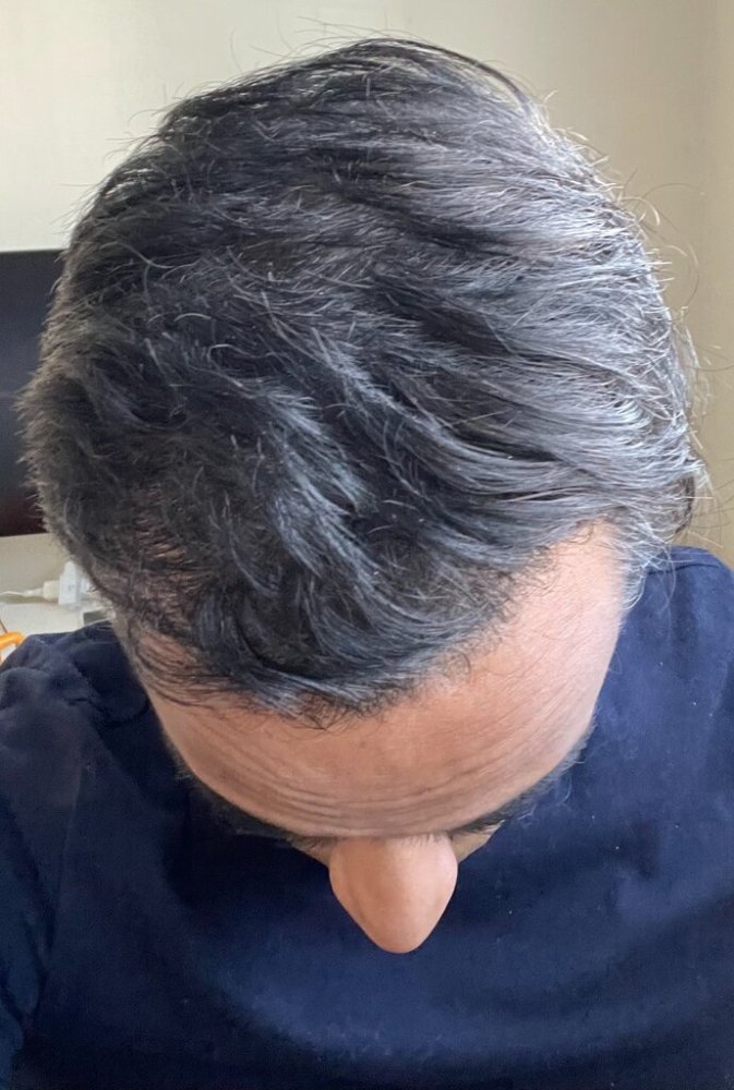 2870 FUT Hair Transplant with Dr. Ron Shapiro - Shapiro Medical Group ...